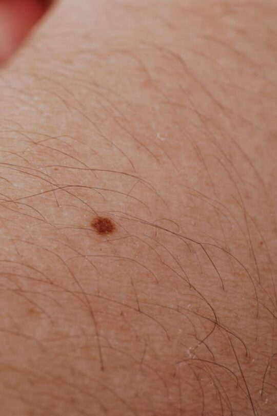 Autumn- the perfect time for a skin check - The Shepparton Adviser